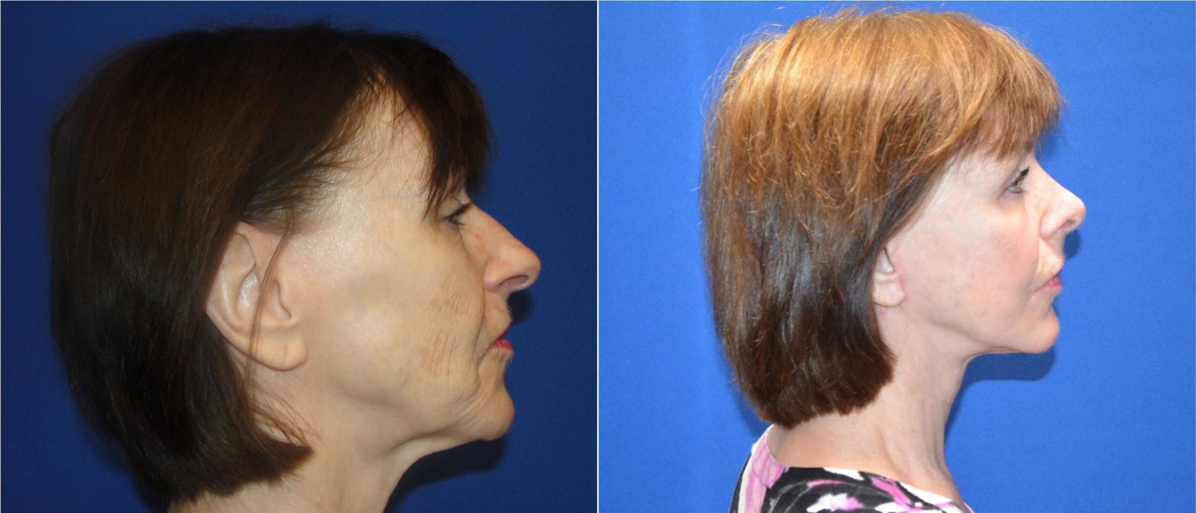 Eyelid Surgery Case #52