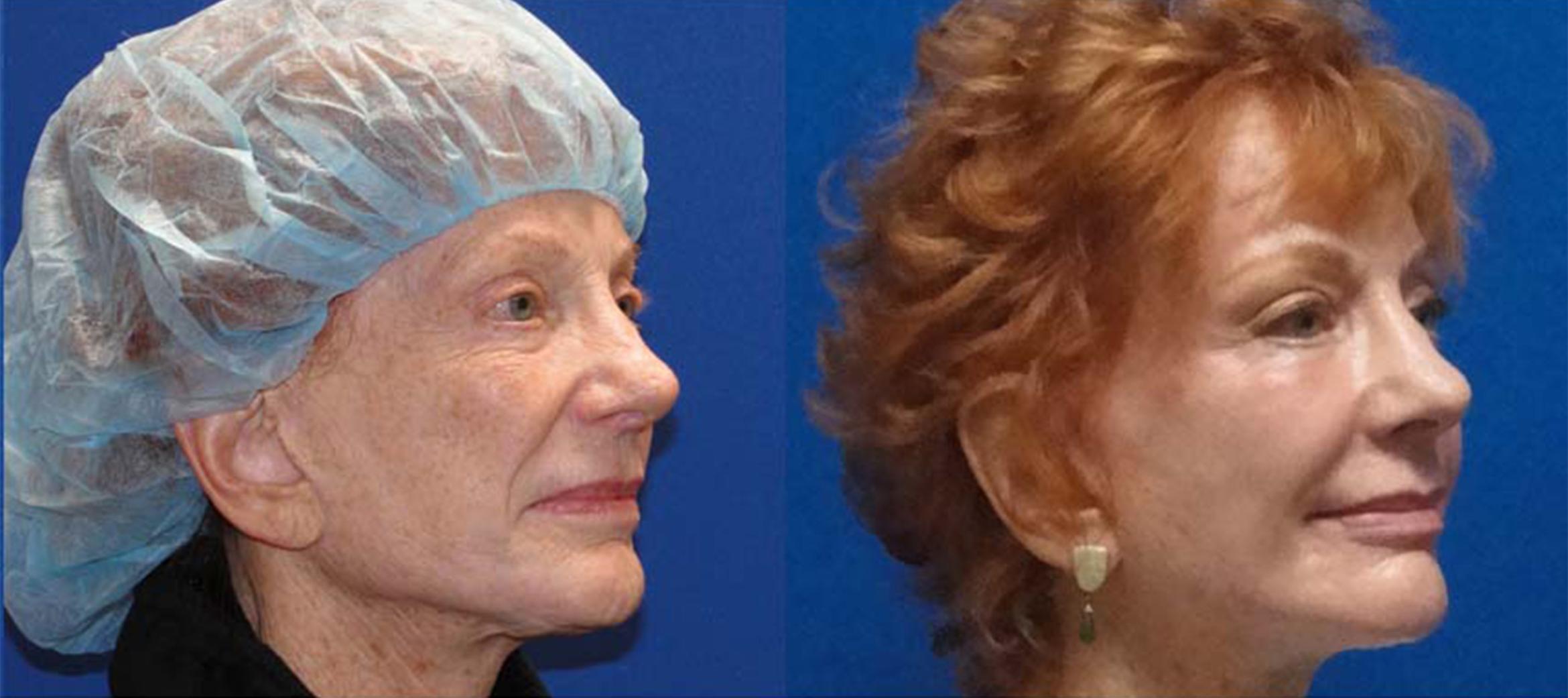 Laser Skin Resurfacing Before and After Pictures Case 12 | Lafayette ...