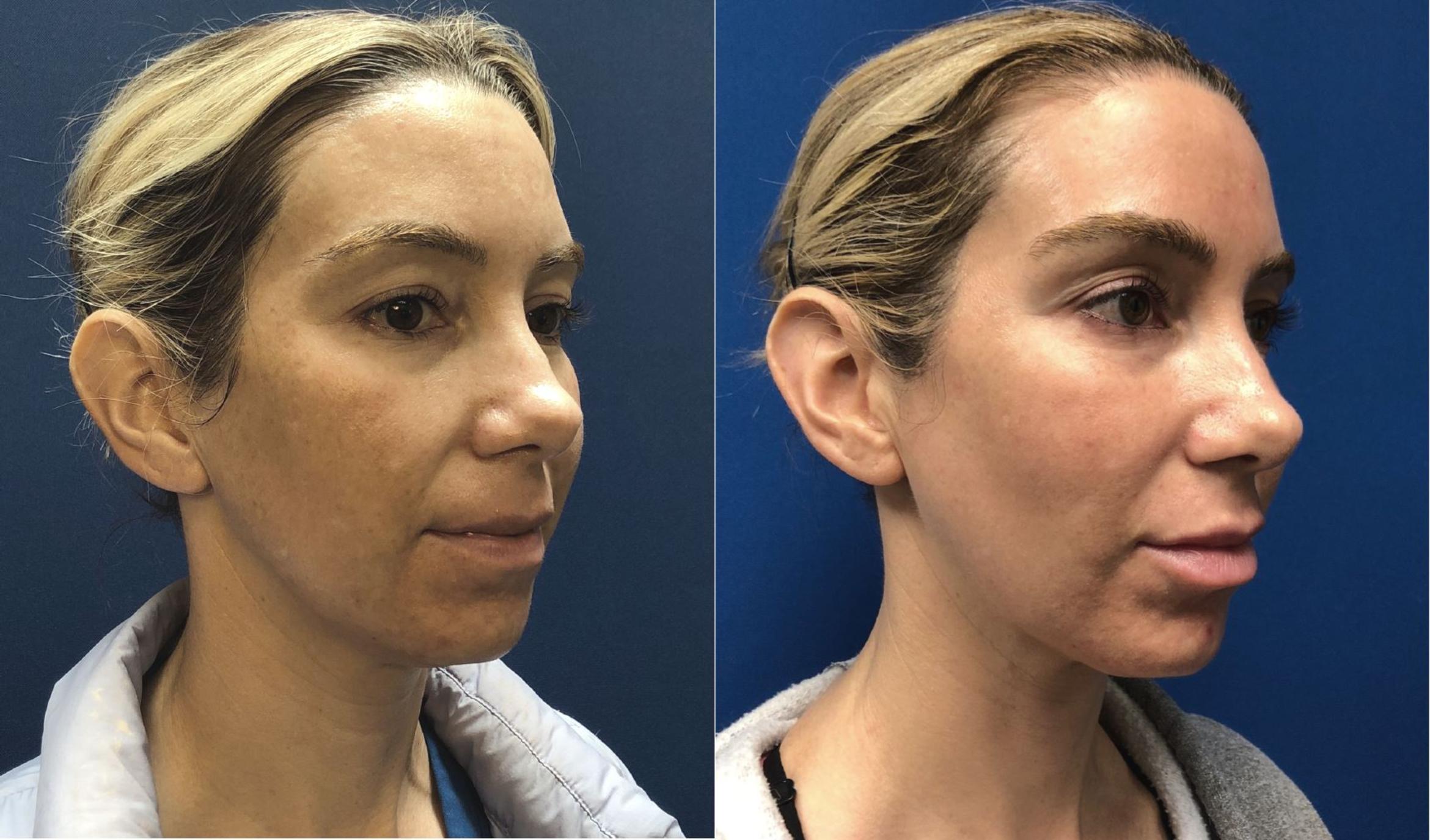 Laser Skin Resurfacing Case #33